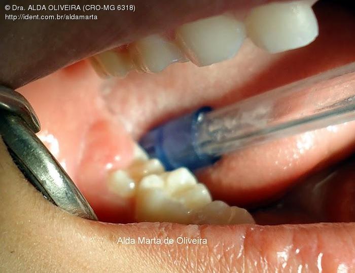 Ulectomia, Caso clínico | iDent
