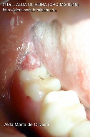 Ulectomia, Caso clínico | iDent