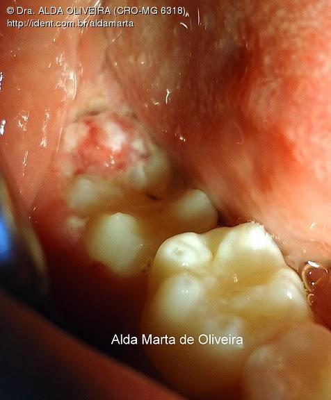 Ulectomia, Caso clínico | iDent