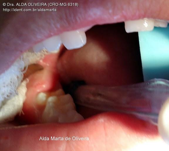 Ulectomia, Caso clínico | iDent
