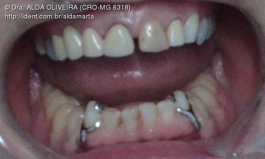 Dente 21: Pino Rosqueável + Provisório + Coroa Total em Cerômero, Caso ...