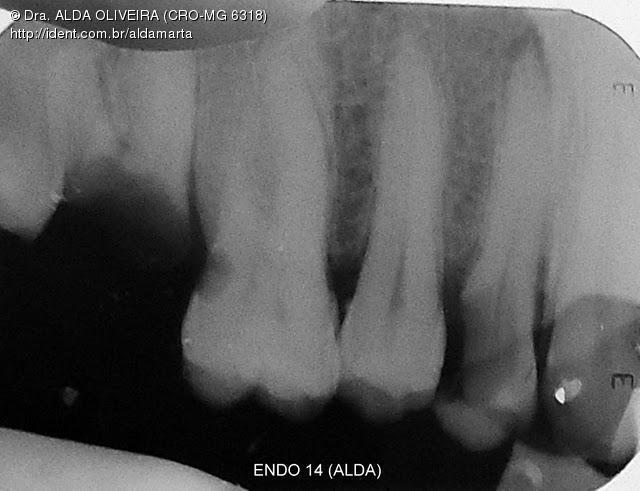 Endo 14: Necropulpectomia, Caso clínico | iDent
