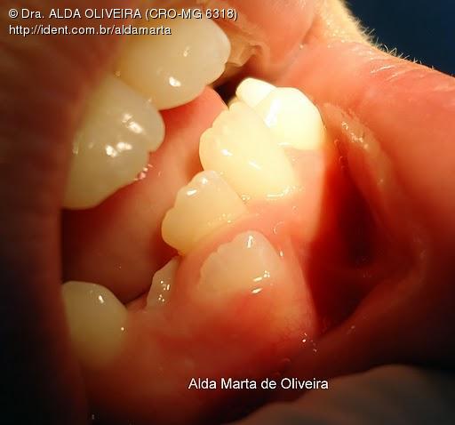 Supra-Numerário na Região do 41, Caso clínico | iDent