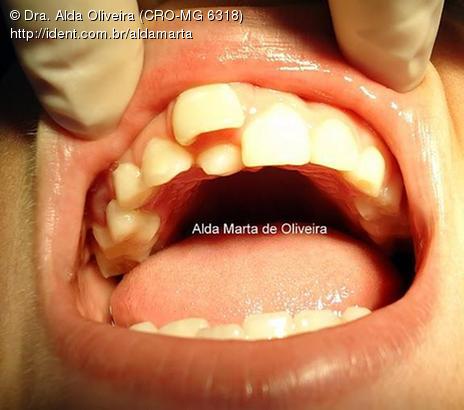Hiperdontia: Supranumerário na Região Palatina do Dente 11, Caso ...