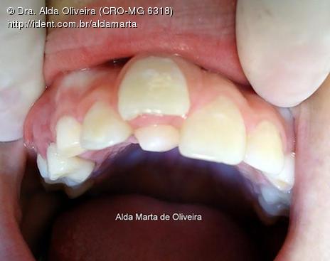 Hiperdontia: Supranumerário na Região Palatina do Dente 11, Caso ...