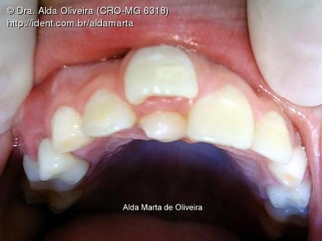 Hiperdontia: Supranumerário na Região Palatina do Dente 11, Caso ...
