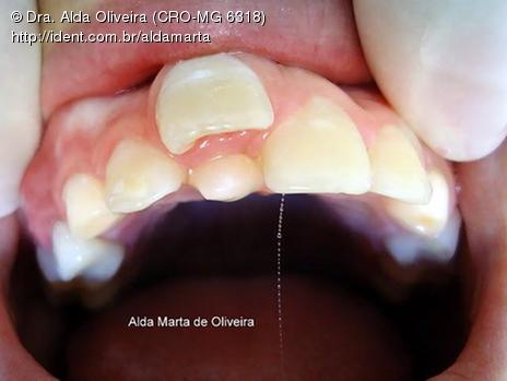Hiperdontia: Supranumerário na Região Palatina do Dente 11, Caso ...