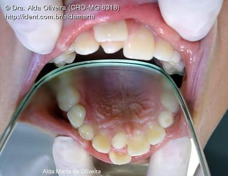 Hiperdontia: Supranumerário na