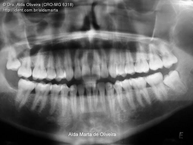 Exérese de 3º Molar Semi-Incluso, Caso clínico | iDent
