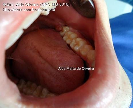 Exérese de 3º Molar Semi-Incluso, Caso clínico | iDent