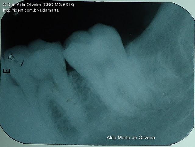 Exérese de 3º Molar Semi-Incluso, Caso clínico | iDent