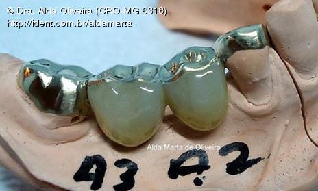 Ppf em Ouro!, Caso clínico | iDent