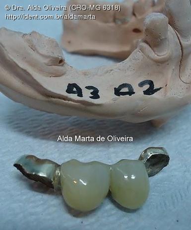 Ppf em Ouro!, Caso clínico | iDent