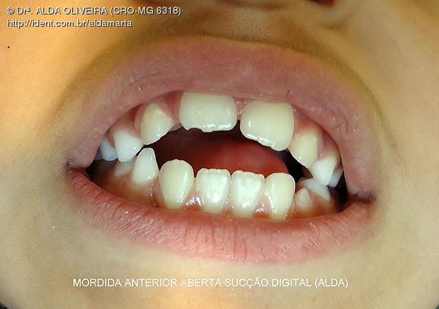 Mordida Aberta Anterior, Sucção Digital, Artigo | iDent