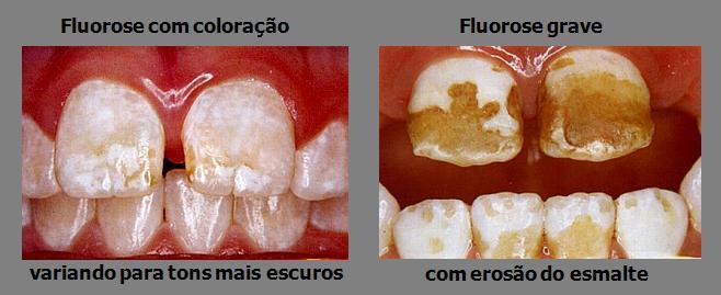 Fluorose Dentária, Artigo | iDent