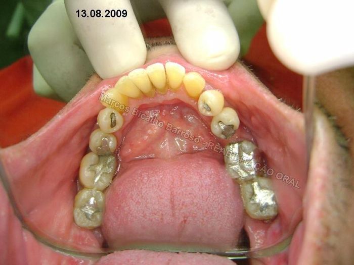 Cirugia Periodontal a Retalho com as Principais Finalidades ...