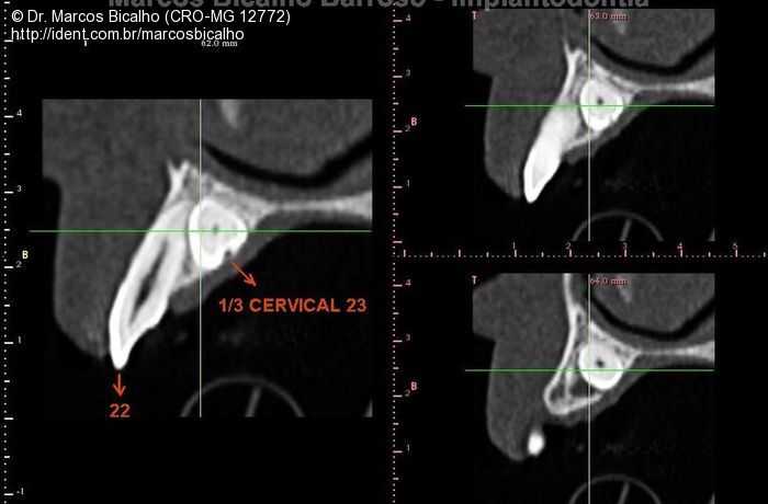 Remoção de Canino Incluso Superior com Regeneração Óssea Guiada, Caso ...