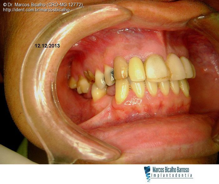 Reabilitação com Implantes em Situações de Colapso Oclusal, Caso ...