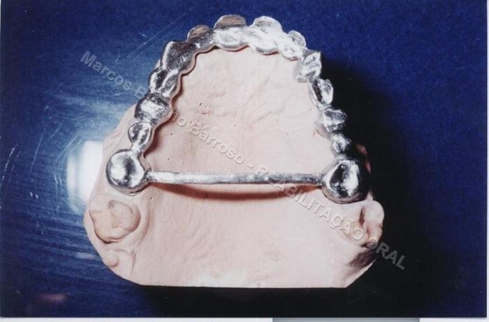 Prótese Fixa Total Superior - 14 Elementos Metalocerâmica - Proservação ...