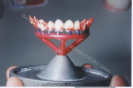 Prótese Fixa Total Superior - 14 Elementos Metalocerâmica - Proservação ...