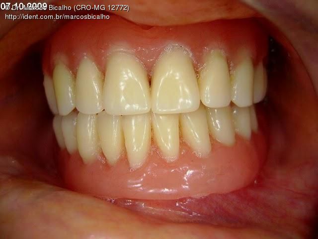 Protocolo Inferior com 5 Implantes - Parte I - Planejamento + Cirurgia ...