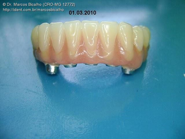 Protocolo Inferior com 5 Implantes - Parte Ii - Fase Protética, Caso ...