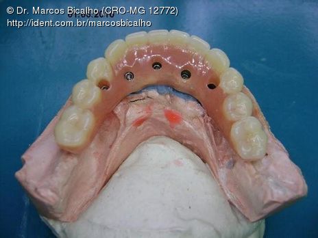 Protocolo Inferior com 5 Implantes - Parte Ii - Fase Protética, Caso ...