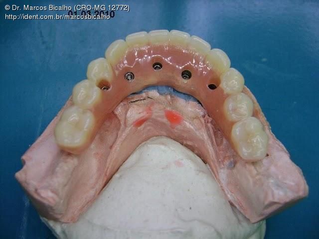 Protocolo Inferior com 5 Implantes - Parte Ii - Fase Protética, Caso ...