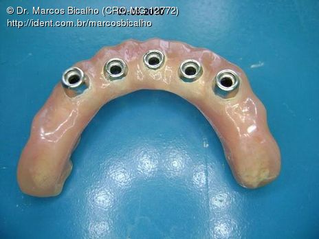 Protocolo Inferior com 5 Implantes - Parte Ii - Fase Protética, Caso ...