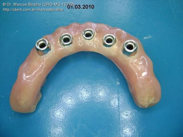 Protocolo Inferior com 5 Implantes - Parte Ii - Fase Protética, Caso ...