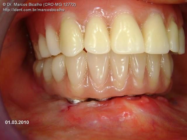Protocolo Inferior com 5 Implantes - Parte Ii - Fase Protética, Caso ...