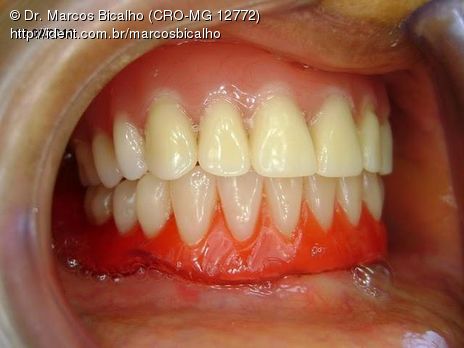 Protocolo Inferior com 5 Implantes - Parte Ii - Fase Protética, Caso ...