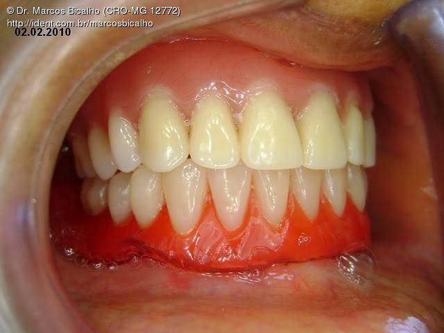 Protocolo Inferior com 5 Implantes - Parte Ii - Fase Protética, Caso ...