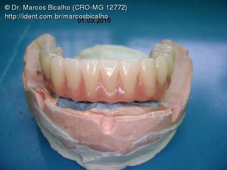 Protocolo Inferior com 5 Implantes - Parte Ii - Fase Protética, Caso ...