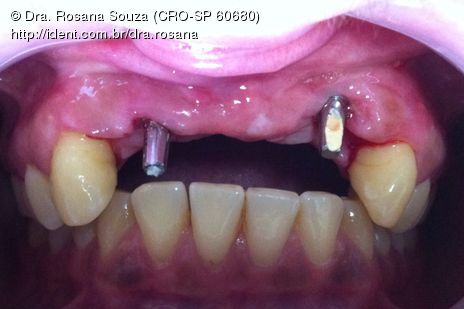 Prótese Fixa Sobre Implantes, Caso clínico | iDent