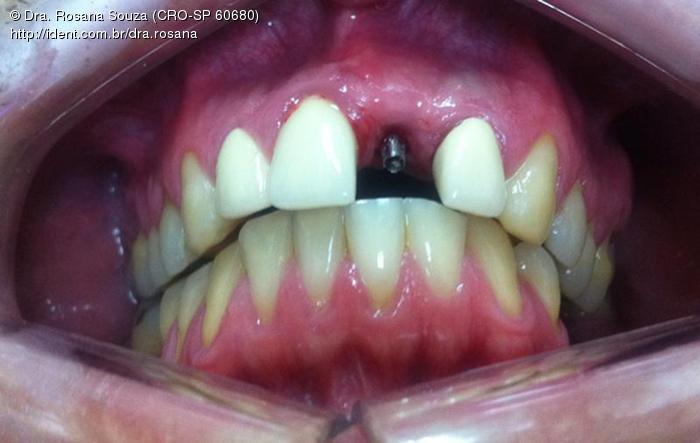 Implante Unitário, Caso clínico | iDent