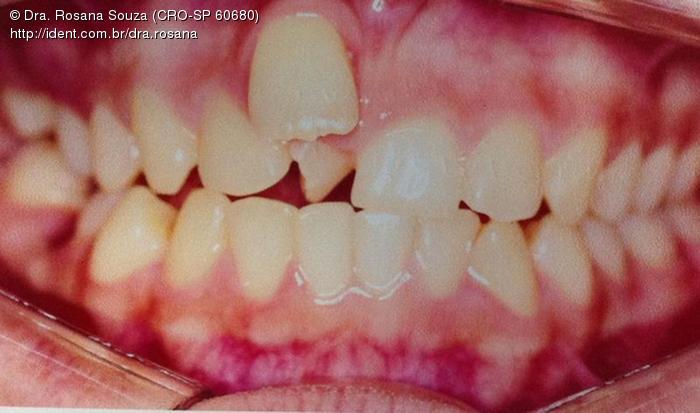 Remoção de Dente Supra Numerário e Ortodontia, Caso clínico | iDent