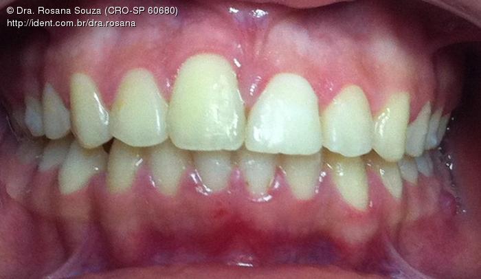 Remoção de Dente Supra Numerário e Ortodontia, Caso clínico | iDent