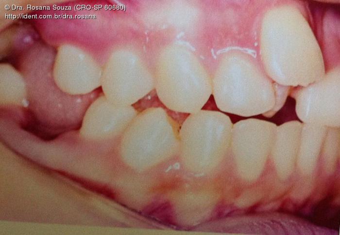 Remoção de Dente Supra Numerário e Ortodontia, Caso clínico | iDent