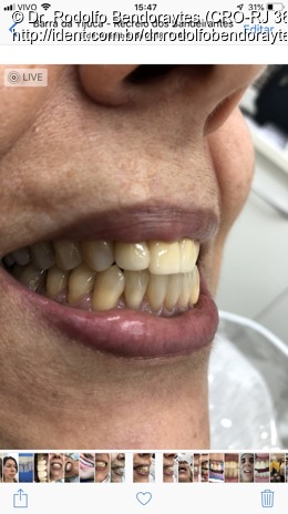 Ponte Fixa Metal Free Anterior, Caso clínico | iDent