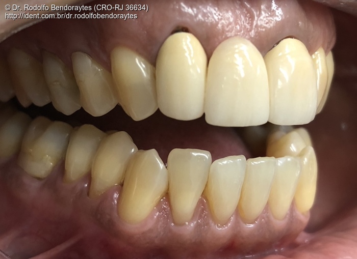 Ponte Fixa Metal Free Anterior, Caso clínico | iDent