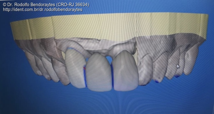 Ponte Fixa Metal Free Anterior, Caso clínico | iDent