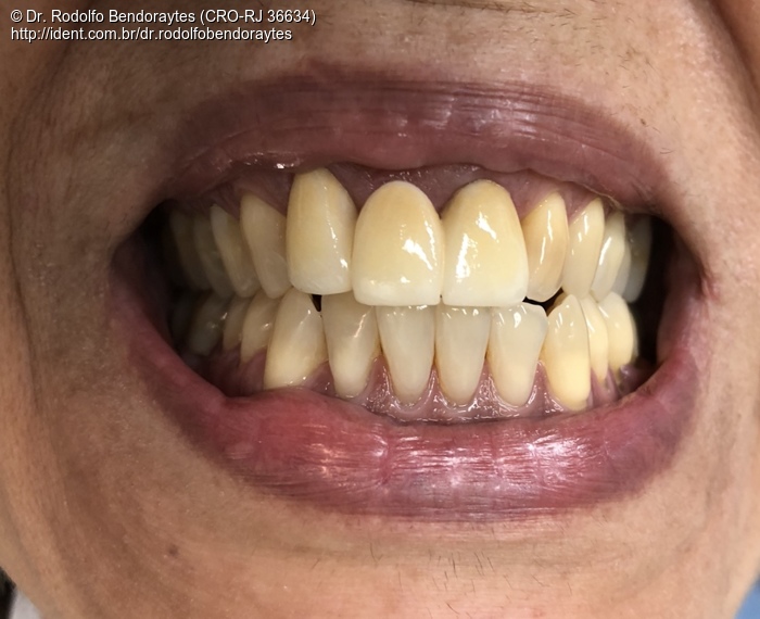 Ponte Fixa Metal Free Anterior, Caso clínico | iDent