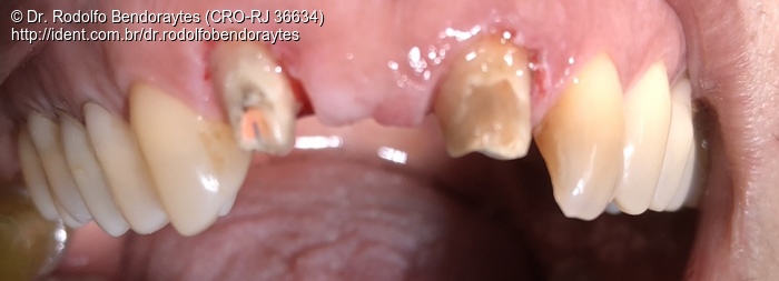 Ponte Fixa Metal Free Anterior, Caso clínico | iDent