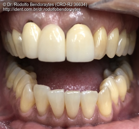 Ponte Fixa Metal Free Anterior, Caso clínico | iDent