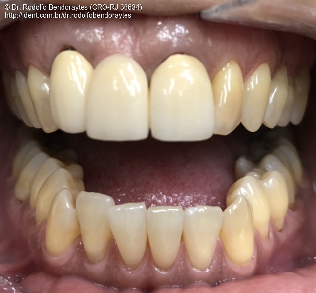 Ponte Fixa Metal Free Anterior, Caso clínico | iDent
