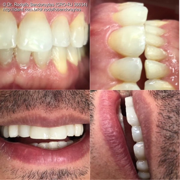Facetas Diretas em Resina Composta, Caso clínico | iDent