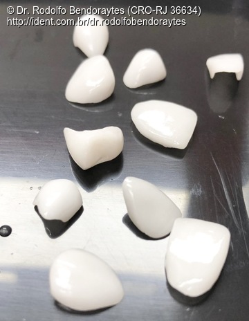 Reabilitação com Facetas em Porcelana Emax Fresadas, Caso clínico | iDent