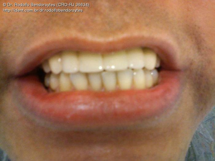 Protese Fixa de 8 Elementos, Caso clínico | iDent