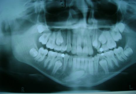 Remoção de Canino Incluso., Caso clínico | iDent